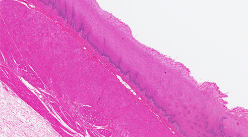 Un naso elettronico per “stanare” l’esofago di Barrett – Popular Science